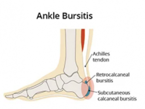 Bursitis in the Foot - Back in Action Physio Injury Information