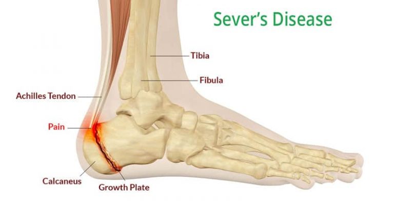 Sever s Disease Image Back In Action
