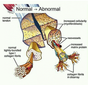 Tendinopathy - correct terms and how to treat them. - Back in Action